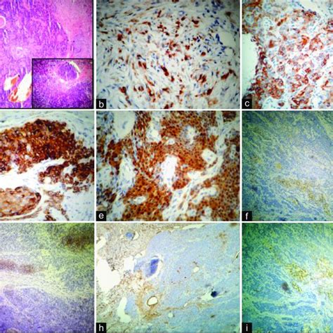 Photomicrograph Showing A Sheets Of Large And Small Basaloid Cells Download Scientific