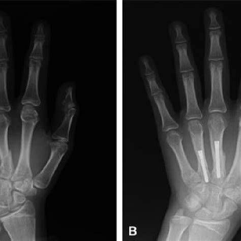 A 22 Year Old Patient With 4 Th And 5 Th Metacarpal Fracture B Download Scientific Diagram