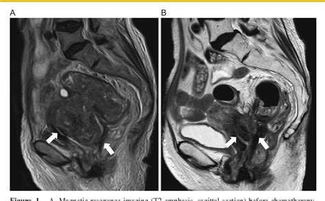 Figure From A Case Of Rectal Cancer With Vaginal Invasion Using Indocyanine Green To Determine