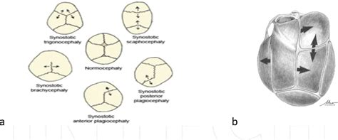 Figure 2 From Advances In Craniofacial Surgery Semantic Scholar