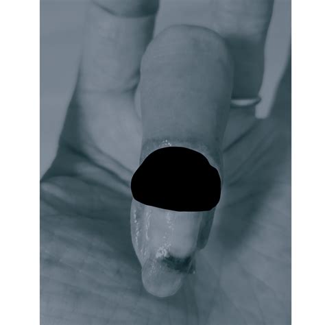 現在の様子20230425 強皮症患者のブログ