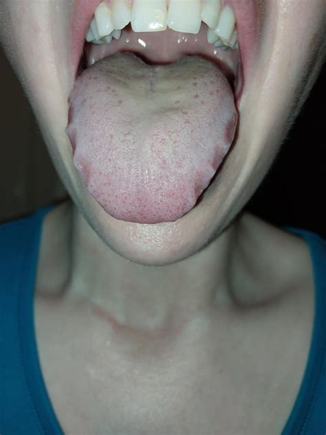 Does This Look Like Oral Thrush Raskdentists