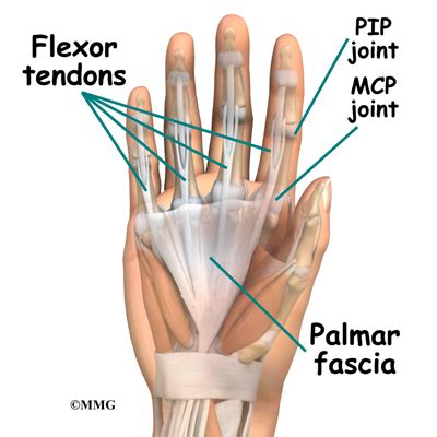 Dupuytrens Contracture