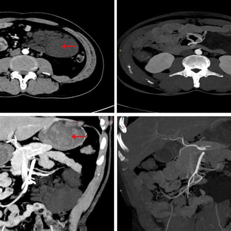 Mesenteric Mass White Arrow In The Abdominal Cavity Download Scientific Diagram