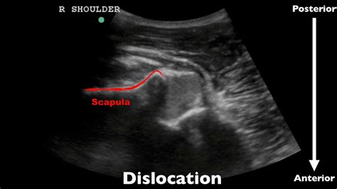 Shoulder Dislocation Core Ultrasound
