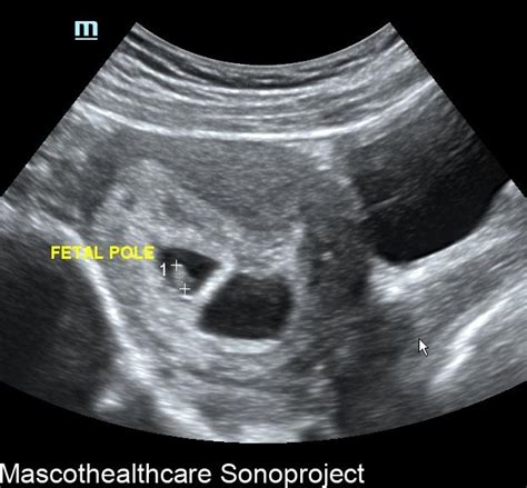 Subchorionic Fluid Mascot Healthcare Sonoproject