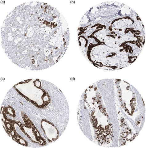 Patchy Moderate To Strong A Diffuse Strong B C And Mosaic