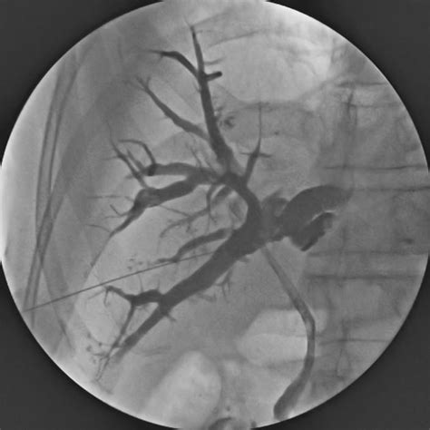 Percutaneous Transhepatic Cholangiography