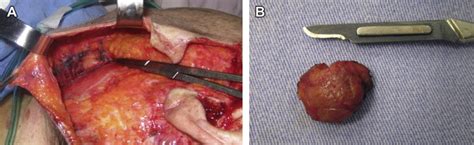 The Lopp—lateral Overlapping Plication Of The Platysma Plastic