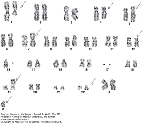 Chronic Myeloid Leukemia Oncohema Key