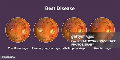 Stages Of Best Vitelliform Macular Dystrophy Illustration High Res