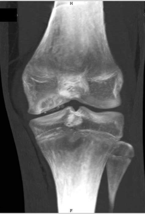 Avascular Necrosis Of Medial Femoral Condyle Musculoskeletal