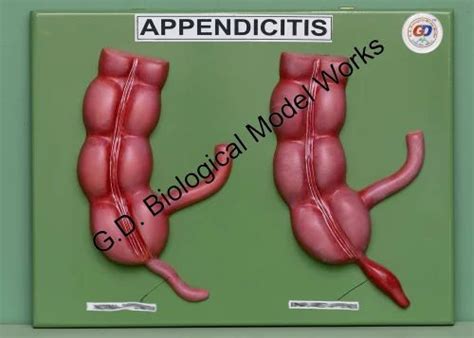 Pathology Models Fat Depositions In The Arteries Model Manufacturer From Ambala