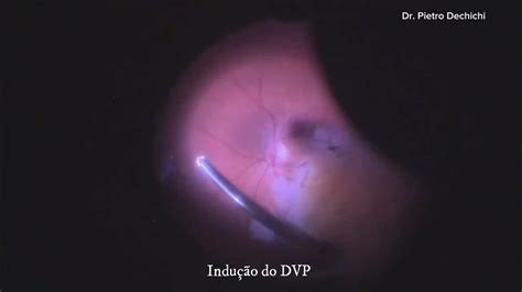 Ppv Dislocated Nucleous Removal Secondary Iol Implantation Youtube