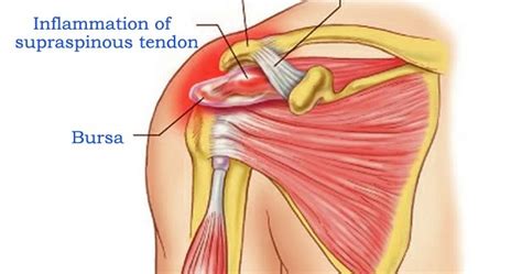 Supraspinatus Tear Signs
