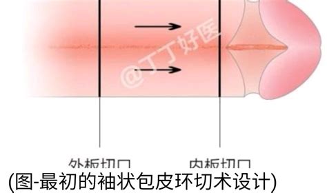 真正的无痕包皮环切技术 健康160