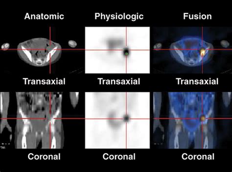 Added Value Of Spectct For Correlation Of Mibg Scintigraphy And Diagnostic Ct In Neuroblastoma