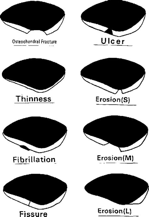 Figure 3 From Double Contrast Ct Arthrography Of The Cartilage