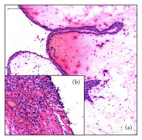 He Staining Showing A Fibroepithelial Polyp With Covering Urothel A Download Scientific