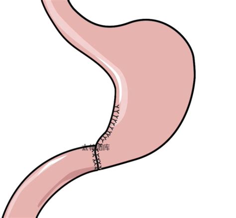 毕Ⅰ式胃大部切除术 医学插画