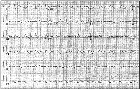 The Stemi Mimic Resus