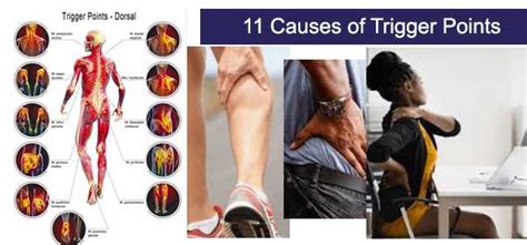 11 Causes Of Trigger Points 1 Overuse 2 Dehydration 3 Stress 4