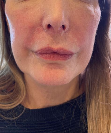 Nasolabial Folds Aesthetic Art Clinic