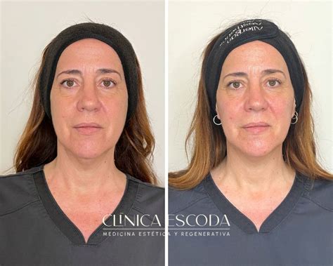 La Importancia Del Pómulo En La Belleza Y La Juventud Del Rostro