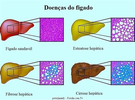 Histologia Hepatica Da Hepatite C Hepatitis C Liver Histology