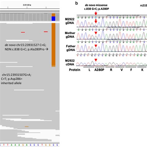 Typical Sms Phenotype With ‘tented Upper Lip And Depressed Nasal