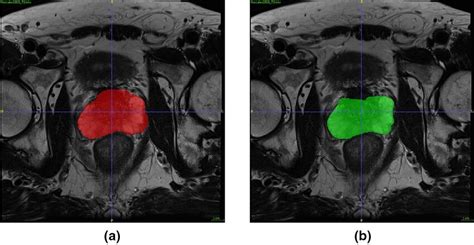 An Example Of The Evident Segmentation Variability In The Masks Drawn