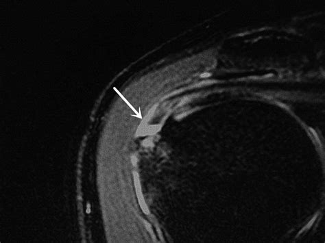 Clinical And Structural Results Of Arthroscopic Repair Of Bursal Side