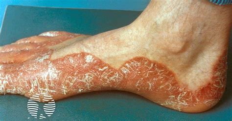 Acquired Palmoplantar Keratoderma Image Acquired Palmoplantar Keratoderma Image
