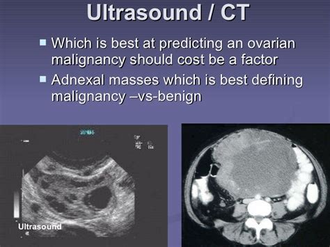 Adnexal Masses