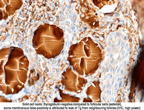 Pathology Outlines Thyroglobulin