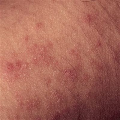 Dermatite Atopique Définition
