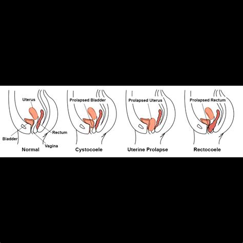 Our Pelvic Malka Schwartz Whole Core And Pelvic Health