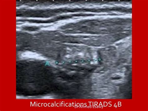 Tirads Thyroid Nodule Imaging Reporting And Data System Dr Ahmed E…