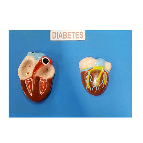 Diabetes Model Yogi Limited Medical Equipment Supplier In Uganda