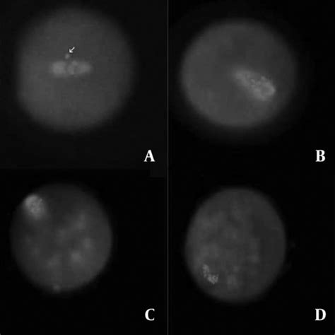 Different Human Oocyte Morphological Abnormalities Arrows Observed By
