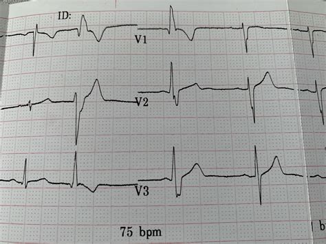 Pvc Location Rreadmyecg