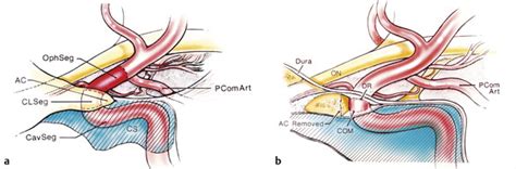 Ophthalmic Segment Aneurysms Neupsy Key