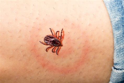 How To Help Arthritis Pain From Lyme Disease Nikki