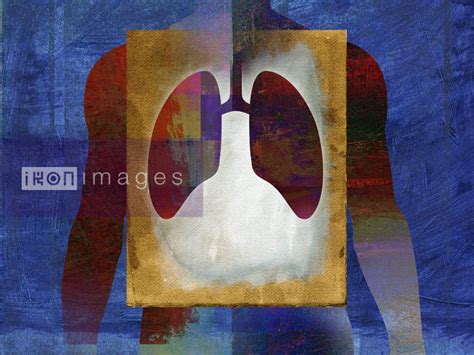 Stock Illustration Of Lung Problem Ikon Images Ikon Images