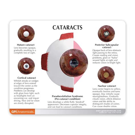 Cataract Eye Education Card Gpi 3d Anatomy