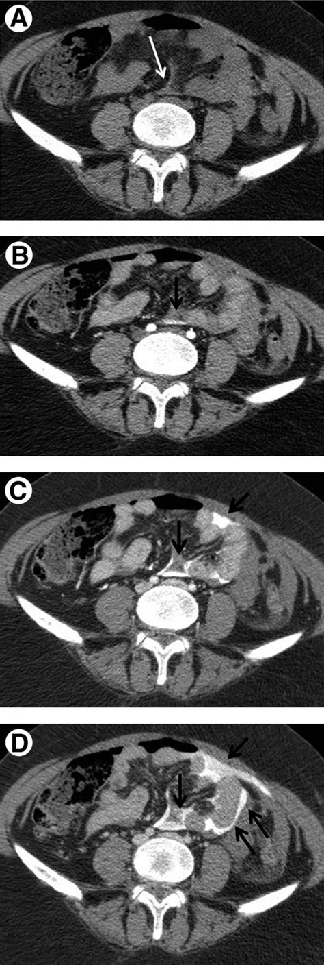 Mdct Of Active Bleeding In The Mesenteric Root And Peritoneal Spaces Download Scientific