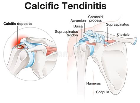 Ilustración Calcifica Tendinitis En El Hombro Etiquetado Stock De
