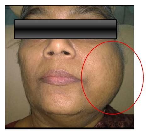 What Disease Causes Swelling Of The Face