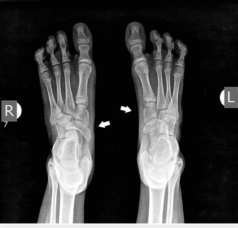 X Ray Of 1st Patients Feet At The Age Of 7 Years With An Enlarged
