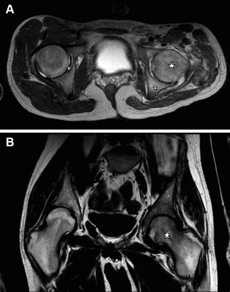 A Axial T2 Weighted Mri Image At Initial Presentation Note The High
